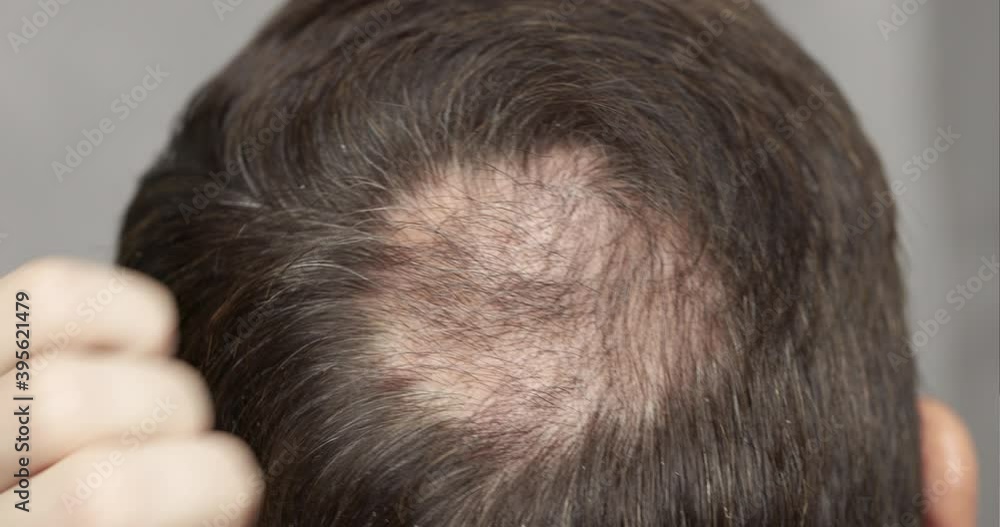 Vidéo Stock Man with hair loss problems close-up. Alopecia balding ...