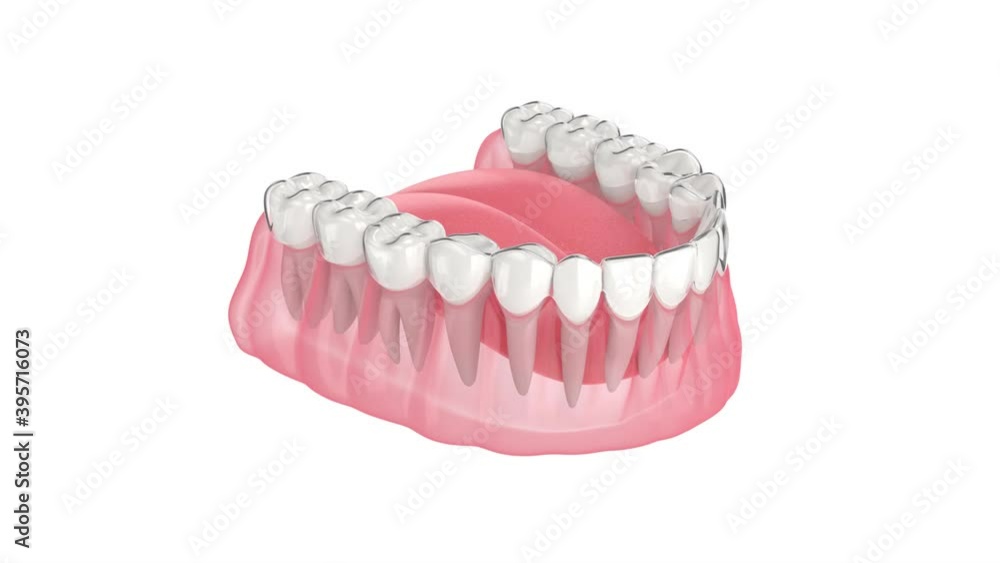 Clear invisalign aligner splint make toothing correction Stock Video ...