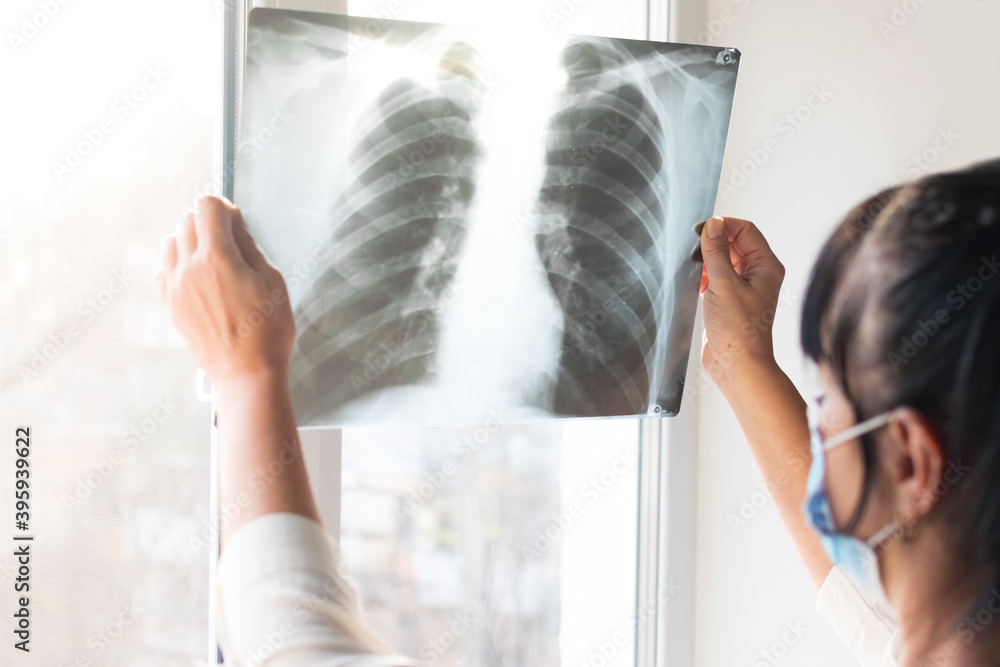 X-ray image of the lungs infected with the coronavirus. The doctor ...