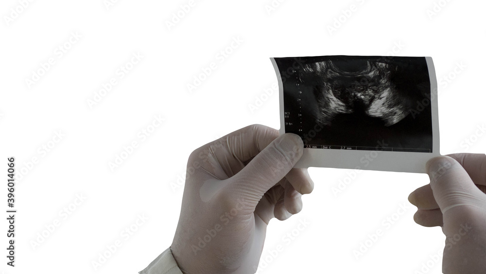 Ultrasound of the prostate in the hands of a doctor, a picture of a ...