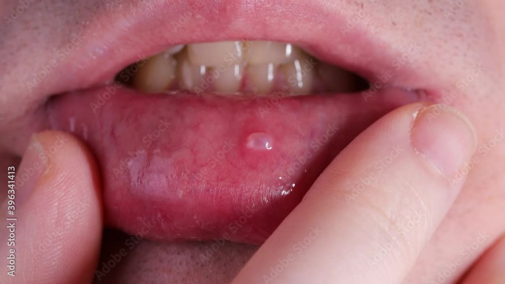 Close Up Of Mucocele On Lower Lip Oral Lesion With Inflammation And