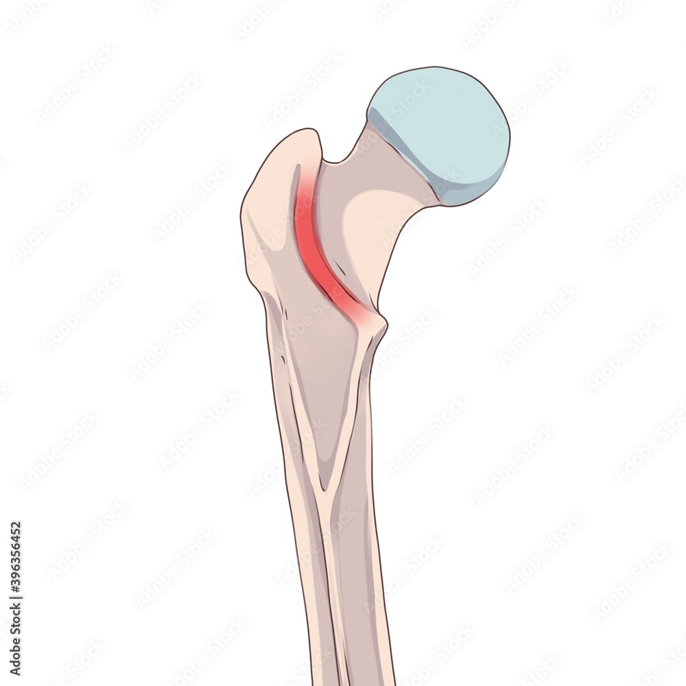 Intertrochanteric crest. The femur, or thigh bone, is the proximal bone ...
