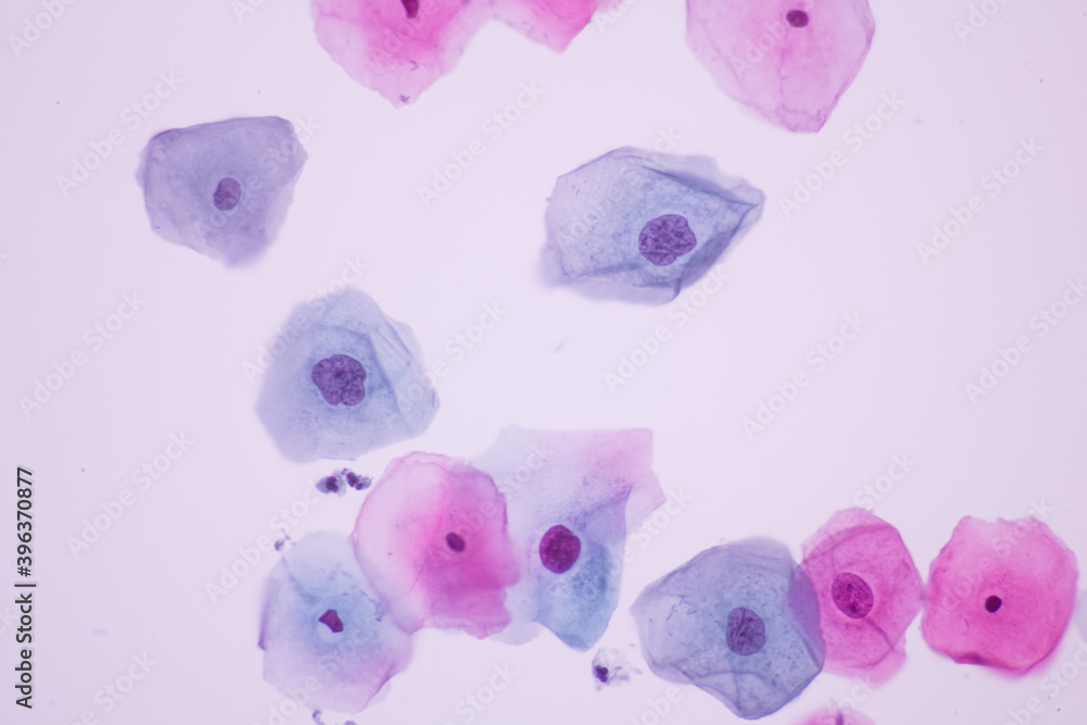 View in microscopic of Abnormal human cervix cells.Squamous epithelium ...
