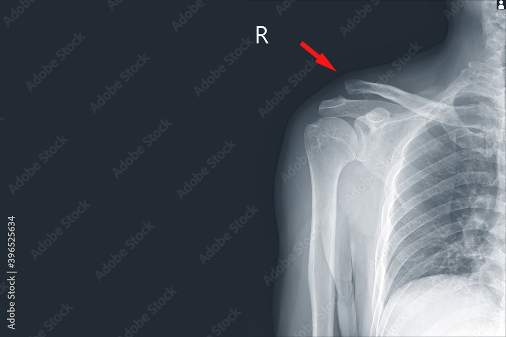 X-ray Right Shoulder Subluation of Rt.Acromioclavicular joint(AC ...