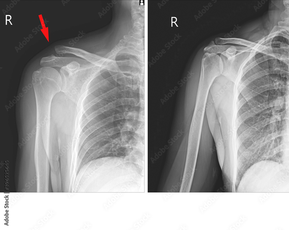 X-ray Right Shoulder Subluation of Rt.Acromioclavicular joint(AC ...