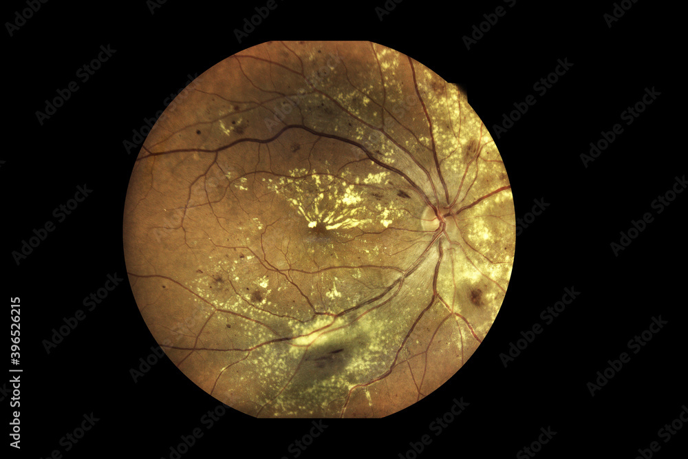 View inside human eye disorders showing retina, optic nerve and macula ...