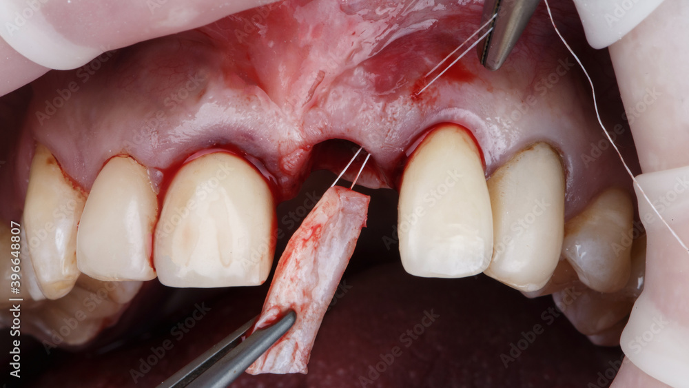 the moment of adding a soft tissue flap after dental implantation Stock ...