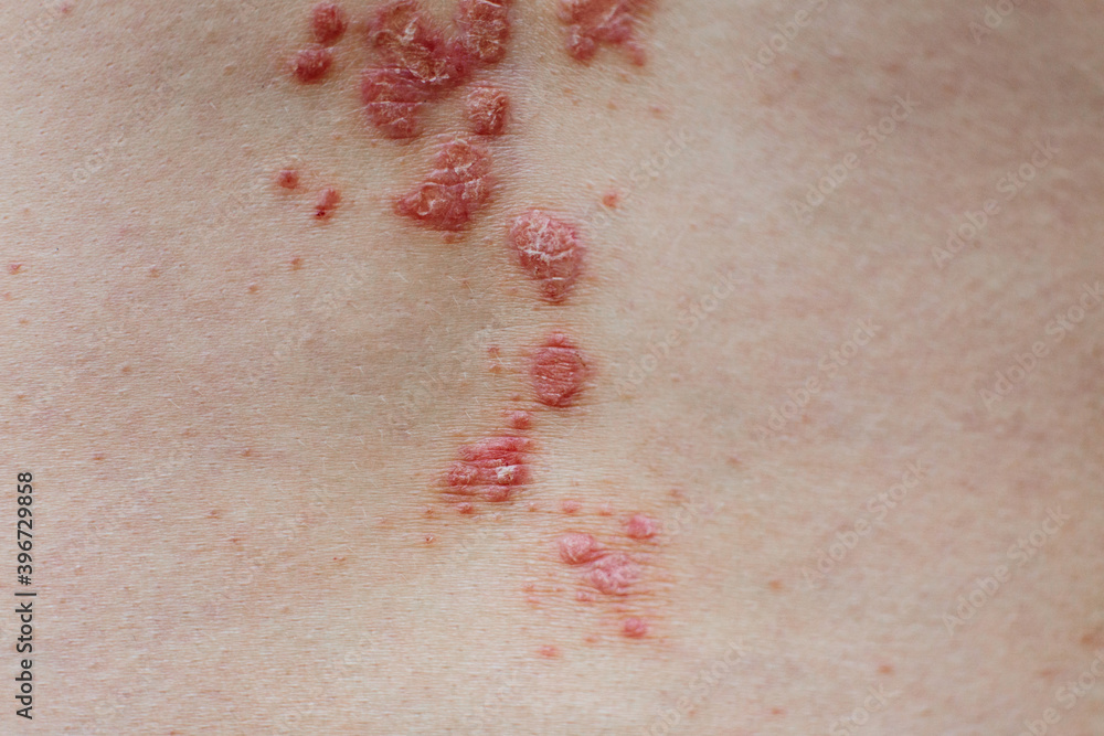 Psoriasis vulgaris skin. Psoriasis is an autoimmune disease that ...