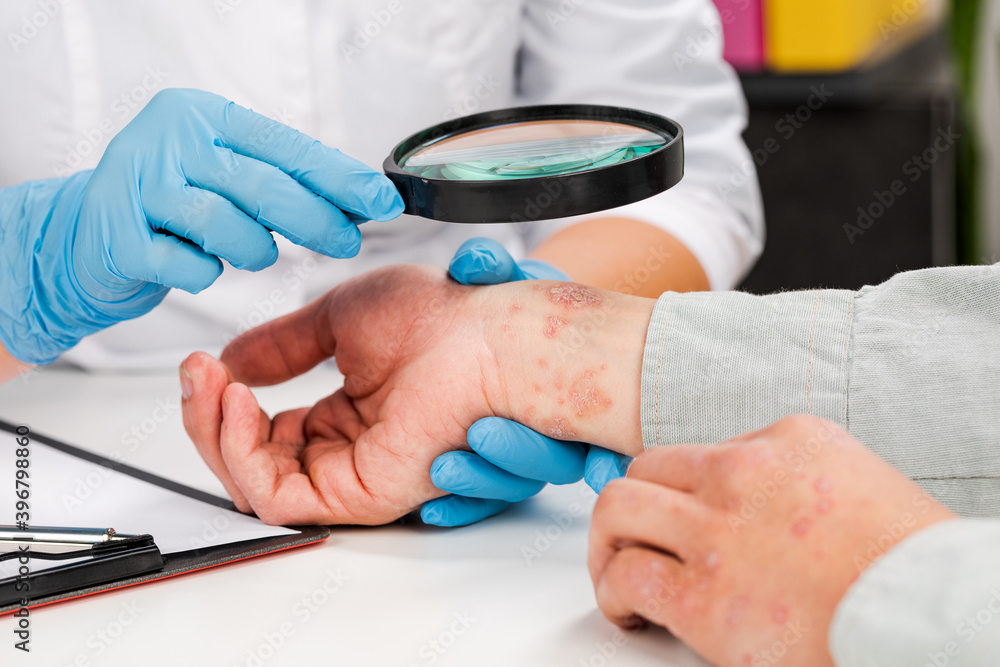 A dermatologist wearing gloves examines the skin of a sick patient ...