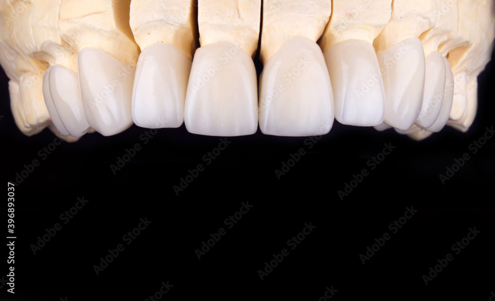 Stockfoto Full mouth teeth made of zircon arch ceramic crowns human ...