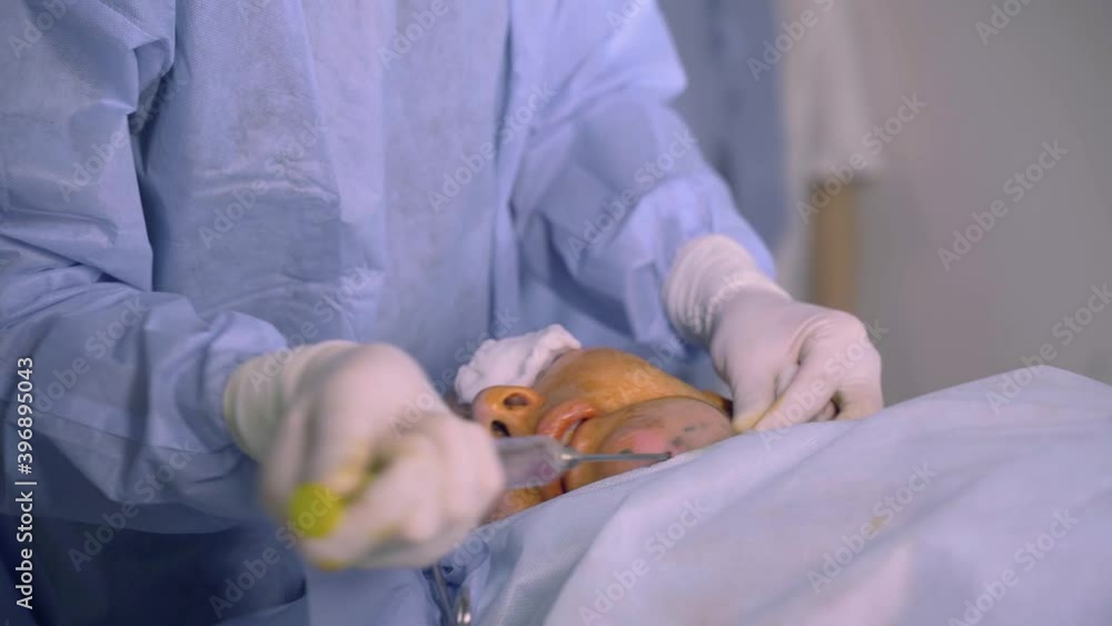 Liposuction of the chin surgery. Pumping out fat in the chin area of a ...