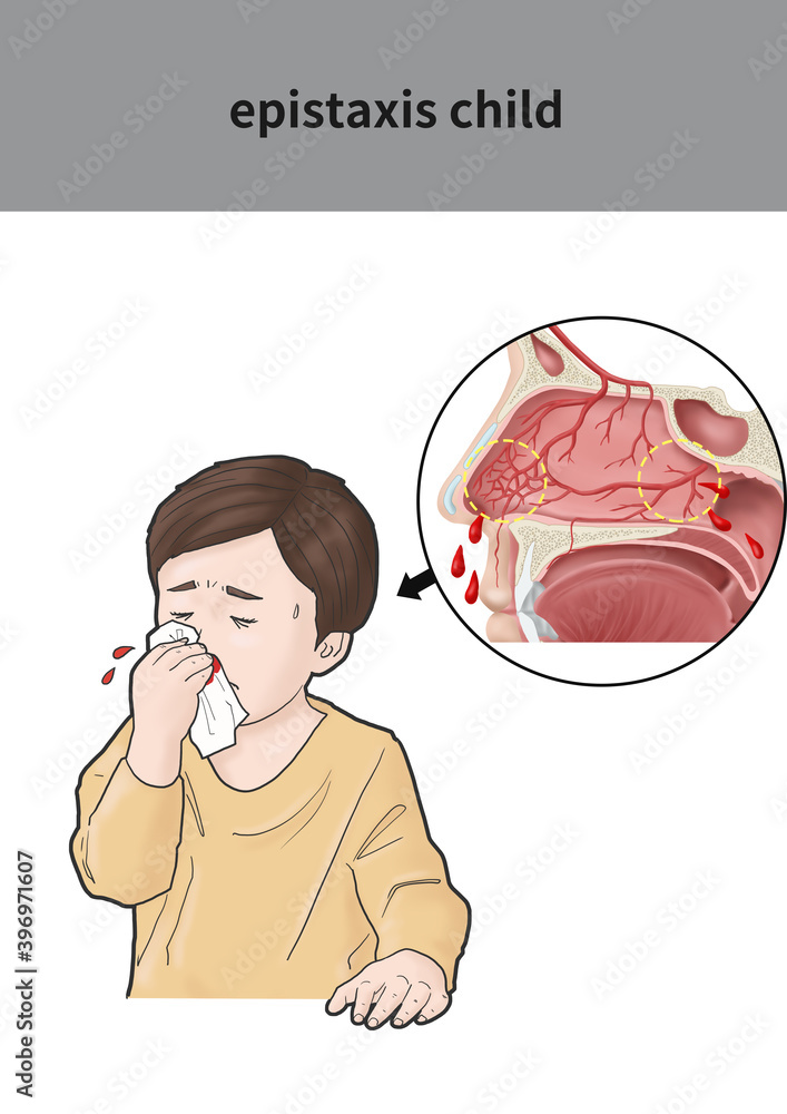 Medical illustration for explanation epistaxis child Stock Illustration ...