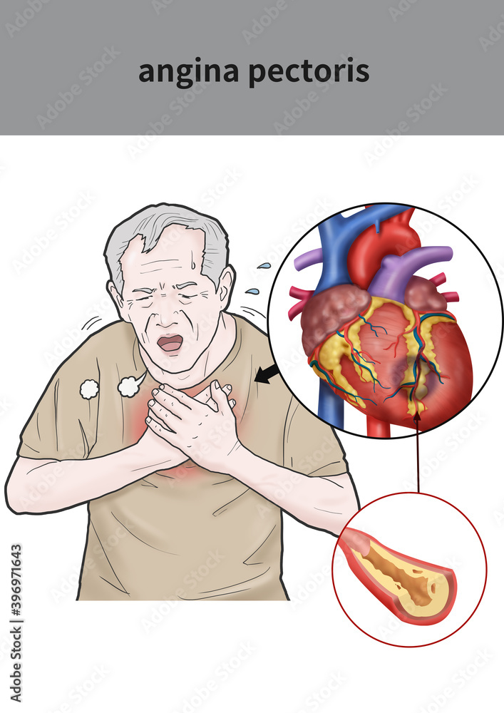 Medical illustration for explanation angina pectoris Stock Illustration ...