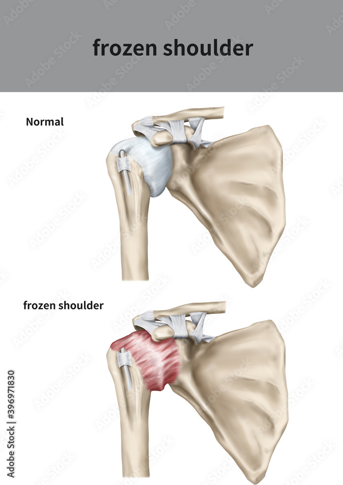 Medical illustration for explanation Frozen shoulder Stock Illustration ...