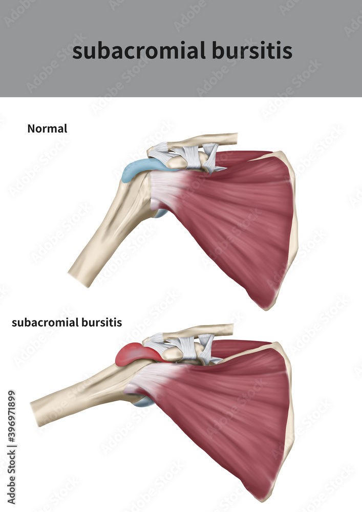 Medical illustration for explanation Subacromial bursitis Stock ...