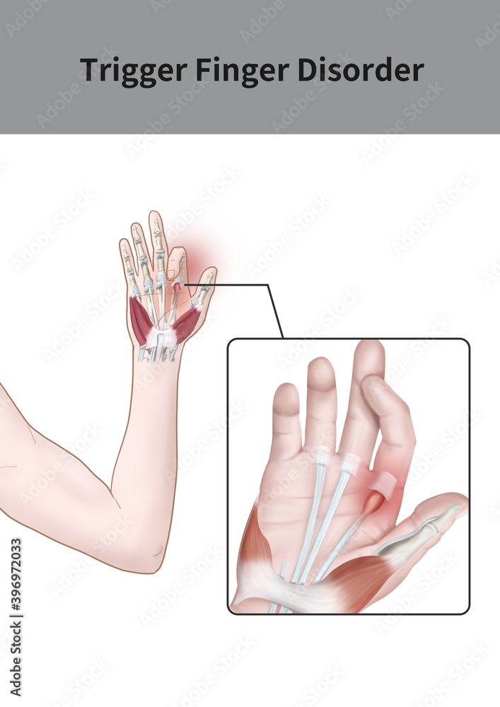 Medical illustration for explanation trigger finger Stock Illustration ...