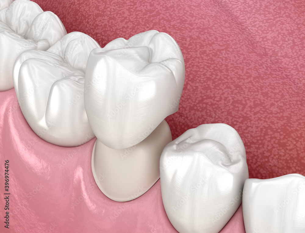 Preparated premolar tooth and dental crown placement. Medically ...