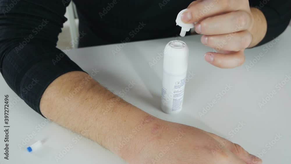 The wart on the arm was treated with salicylic acid. Wart dermatology ...