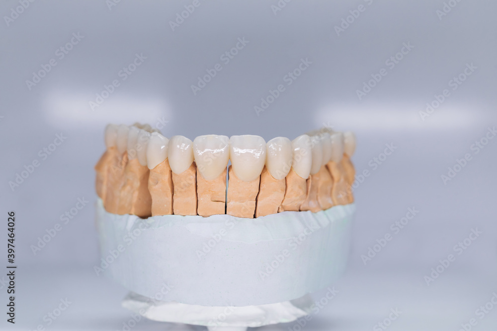 Ceramic tooth crown on plaster model. Finished new ceramic bridge on ...