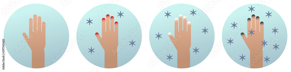 infographic 4 stages of frostbite. Vector illustration Stock Vector ...