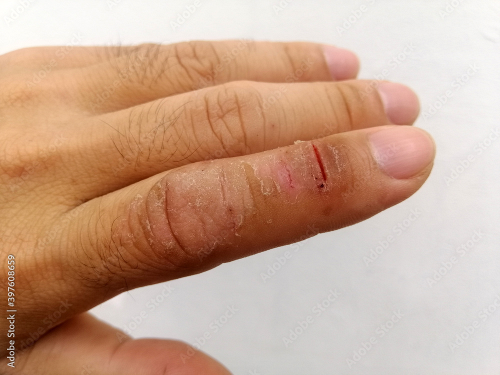 Skin is matt and cracked, the index finger is wound. Finger dermatitis ...