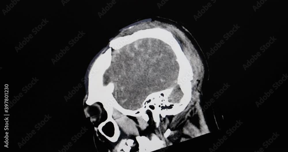 CT cine scan of a patient with falling injury showing severe depression ...