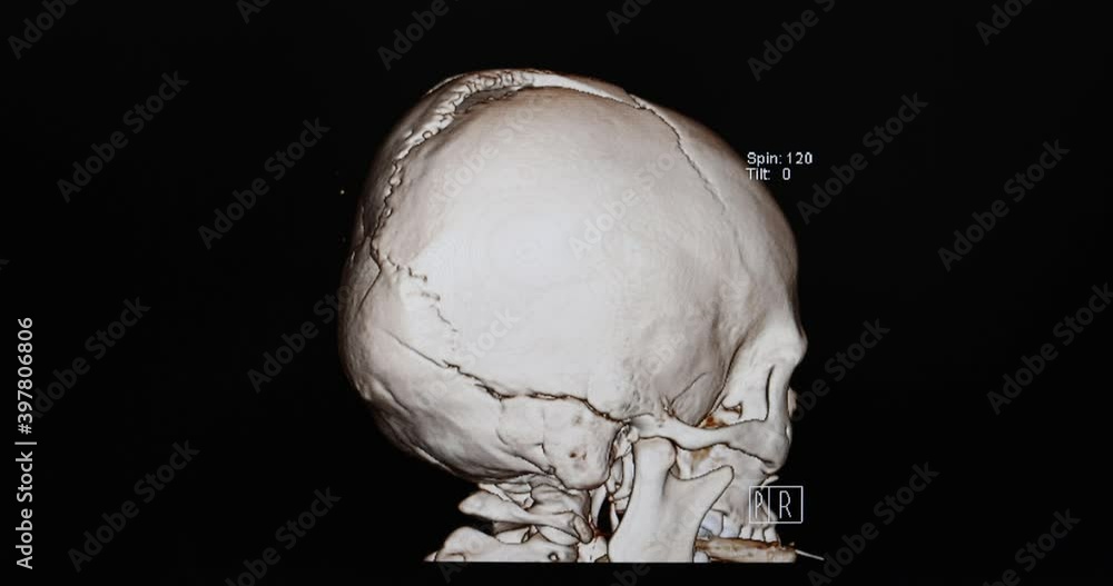 CT cine scan of a patient with falling injury showing severe depression ...