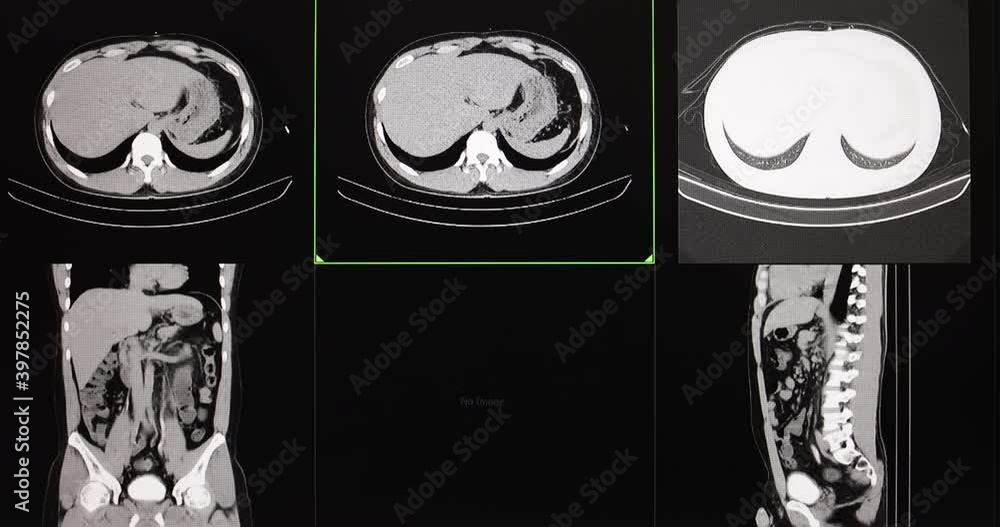 CT cine scan of an abdomen of a patient with two left distal ureteric ...