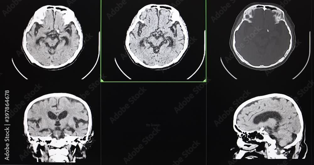 Brain CT cine scan of a patient with diffuse brain atrophy and old ...