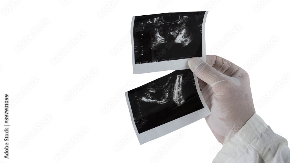 Ultrasound Of The Male Prostate On An Isolated White Background The