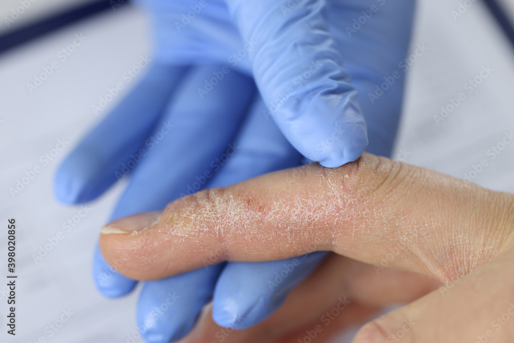 Gloved doctor examines flaky skin of hand. Stock Photo | Adobe Stock