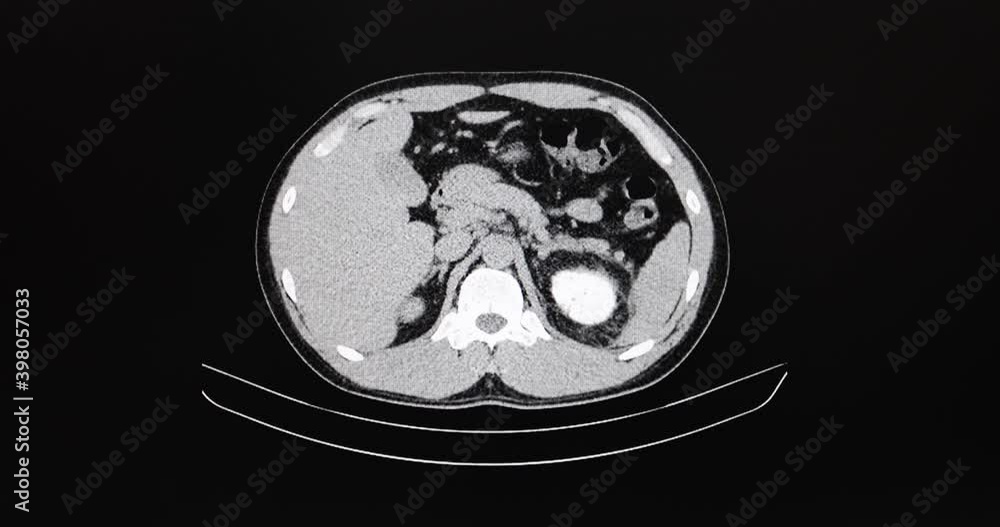 CT cine scan of an abdomen of a patient with two left distal ureteric ...