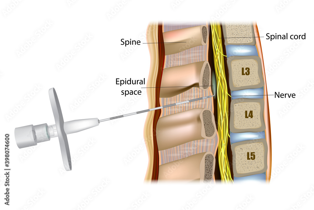 Epidural administration or Epidural anesthesia. Tuohy Epidural Needle ...