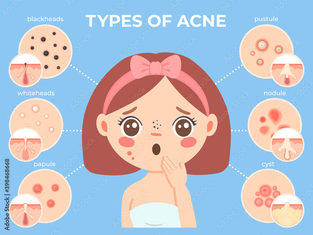 Girl with acne. Young unhappy female face with skin problems and pimple ...