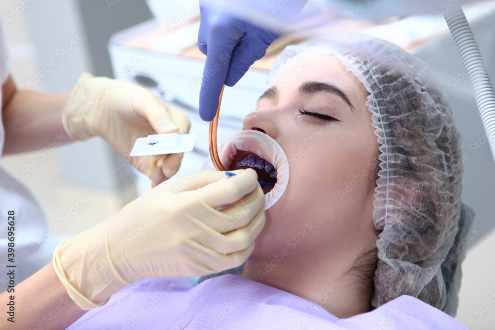 Professional teeth cleaning. The dentist applies a purple gel to the ...