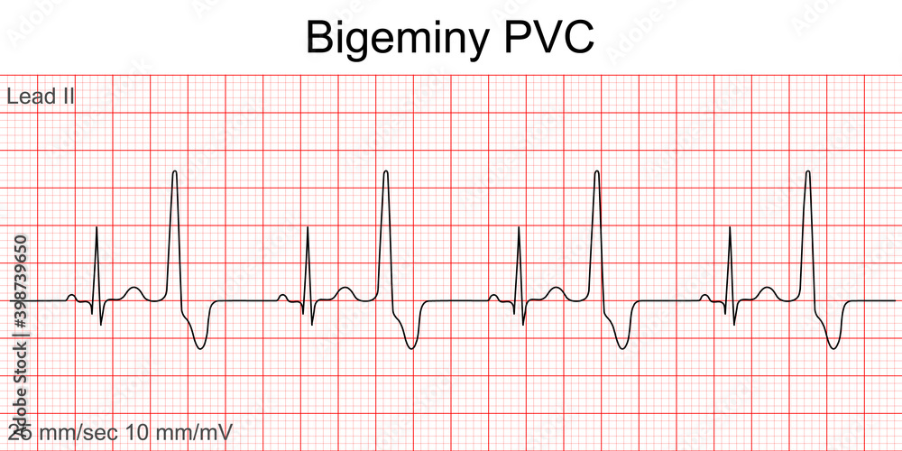 Electrocardiogram show ventricular fibrillation (VF) pattern. Cardiac ...
