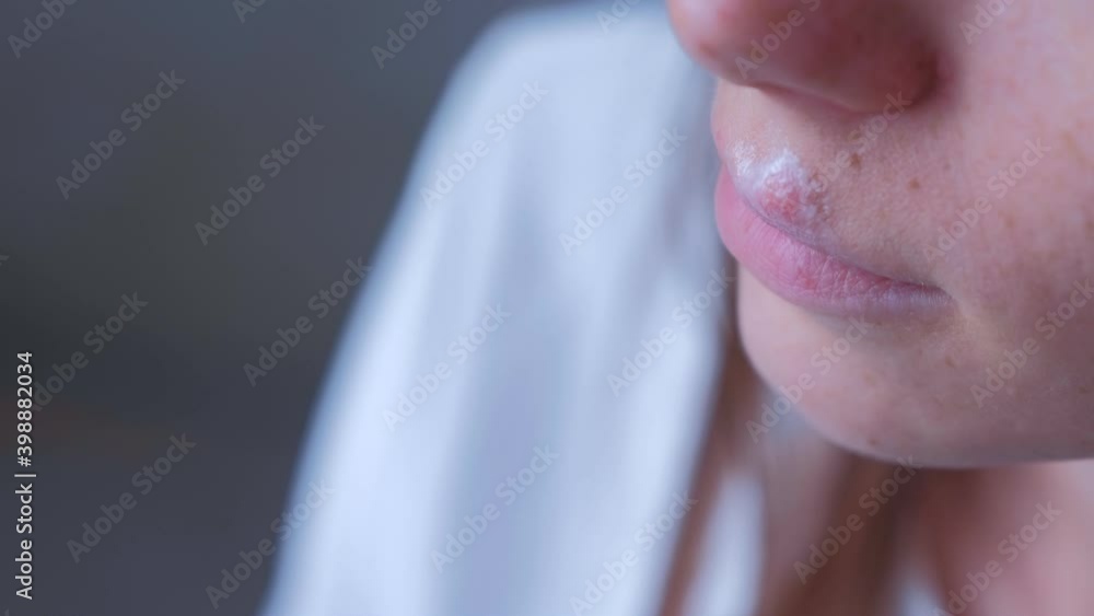 Herpes virus on human lips. Woman with herpes sore on lip mouth with ...