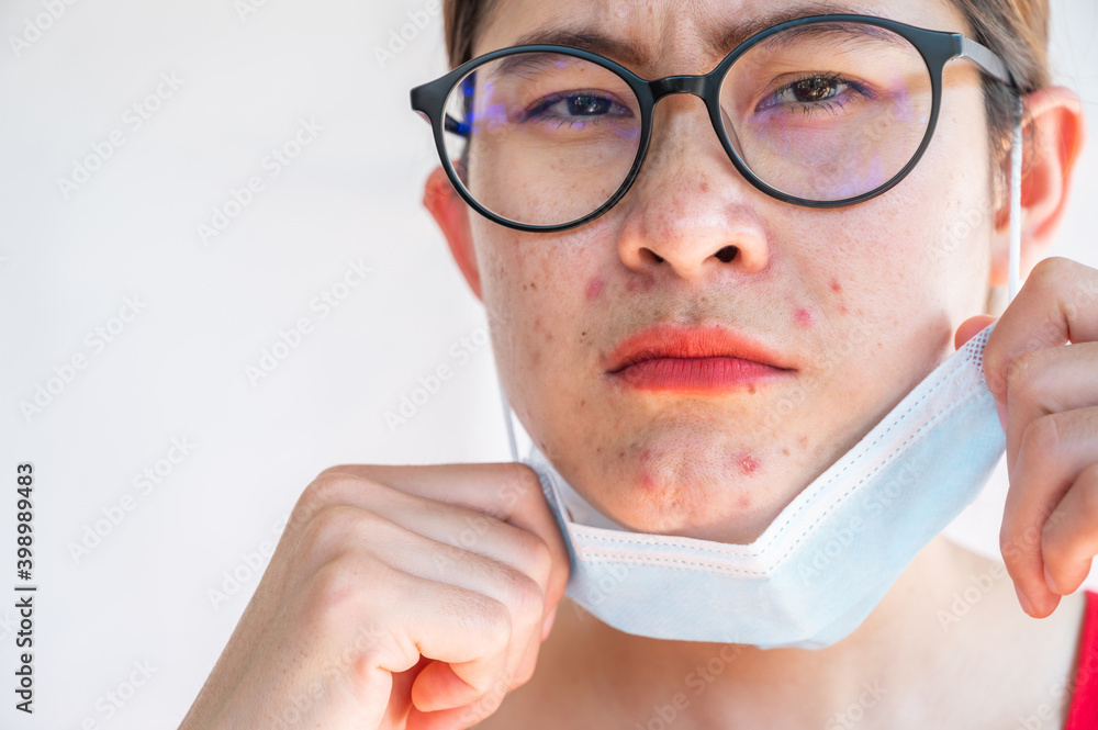 Asian woman worry about acne occur on her face after wearing mask for ...