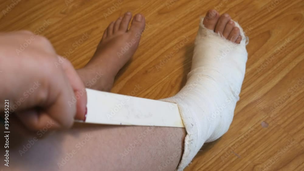 Women leg in a plaster cast toes moving. Itchy legs. Scratches his ...