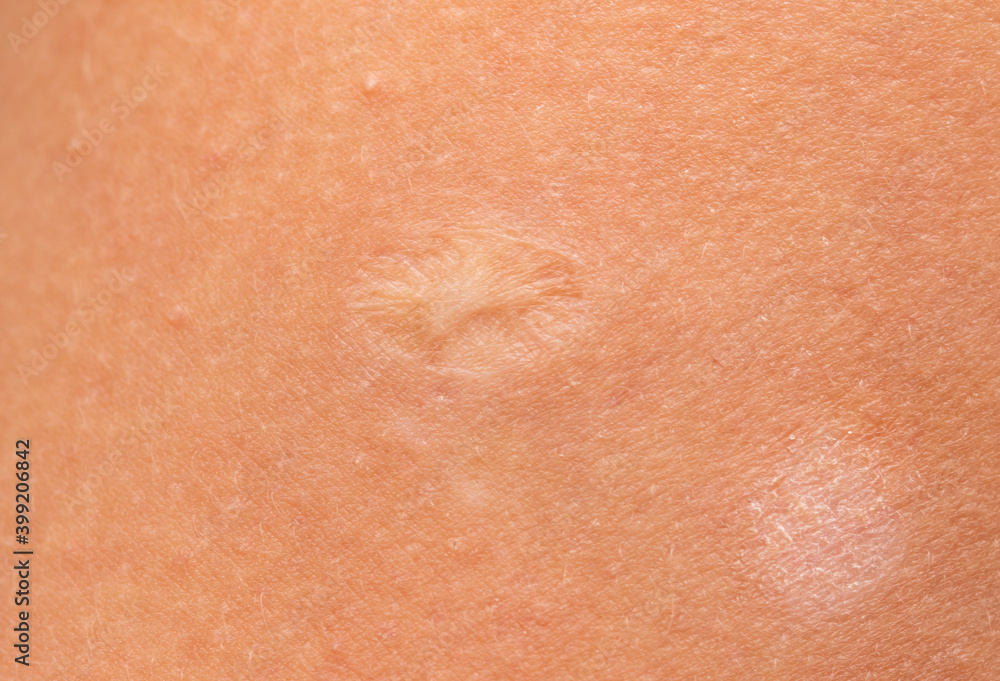 vaccination scar on the skin of the hand Stock Photo | Adobe Stock