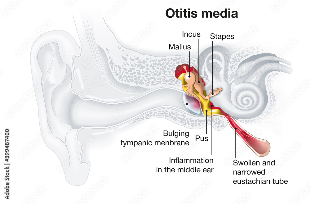 Inflammation of the middle ear, otitis media, medically illustration ...