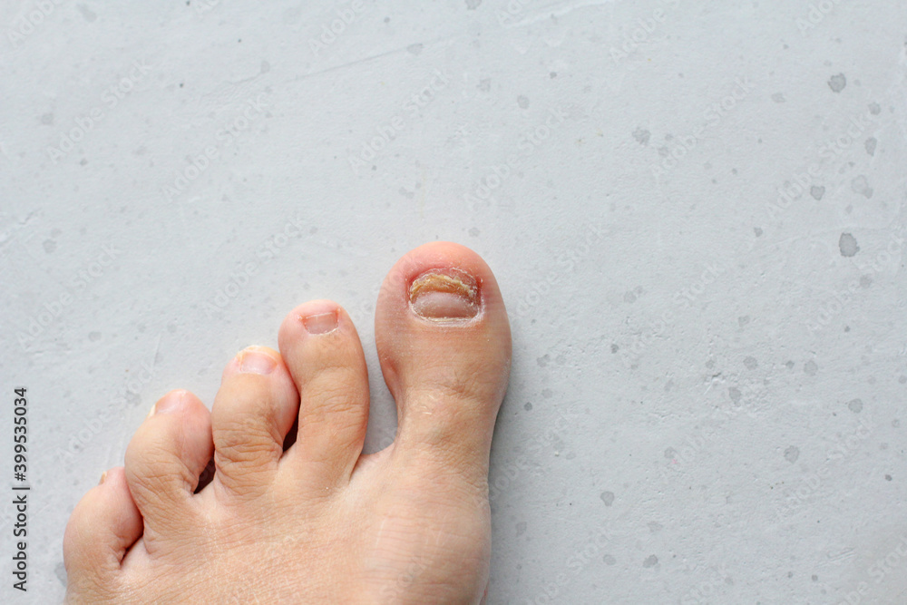 Exfoliation of nail on big toe, close-up in woman, girl. Toenail damage ...