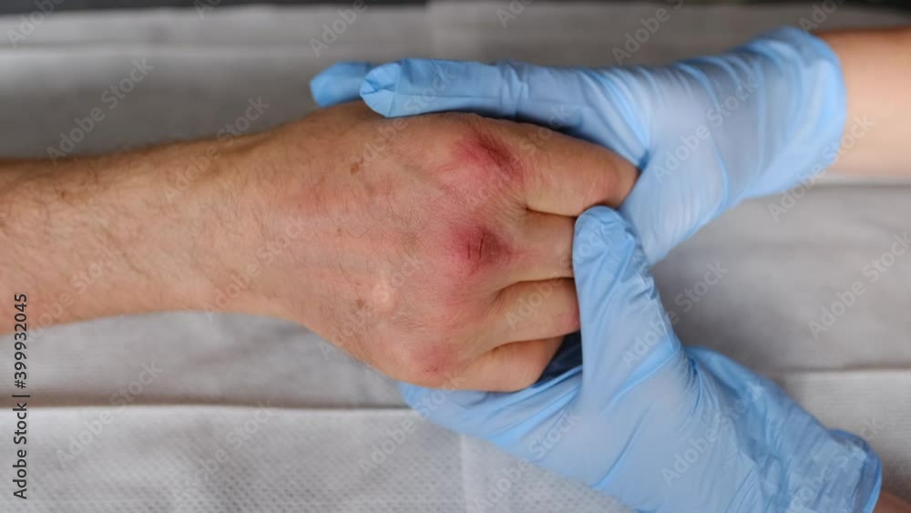 doctor treats healing wound from an allergic reaction to chemicals on ...