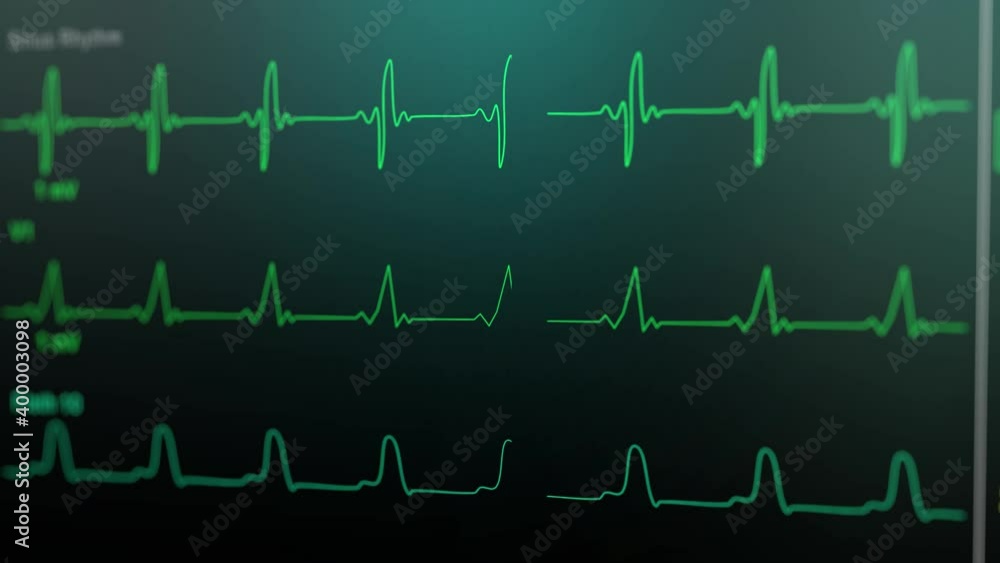 Patient monitor displays vital signs ECG electrocardiogram EKG, oxygen ...