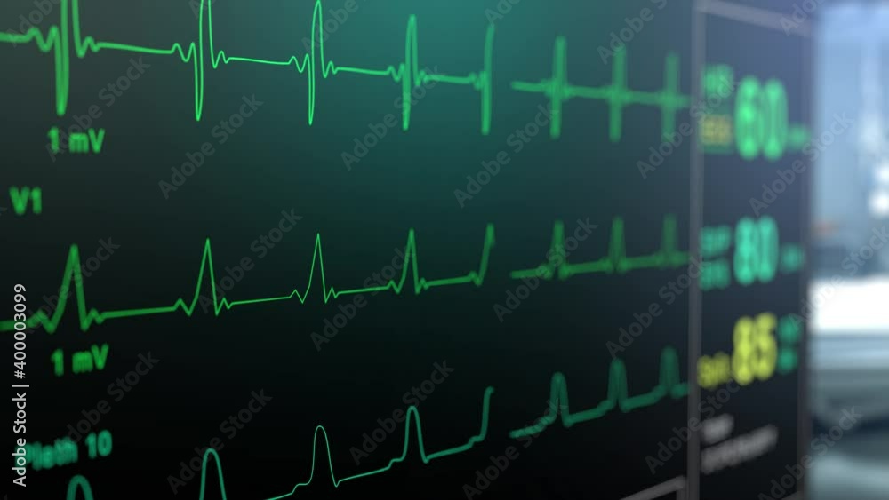 Patient monitor displays vital signs ECG electrocardiogram EKG, oxygen ...