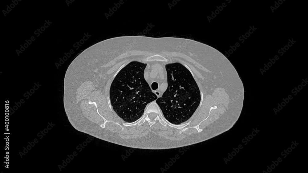MRI of human lungs. Voluminous MRI of the lungs and bronchi, diagnosis ...