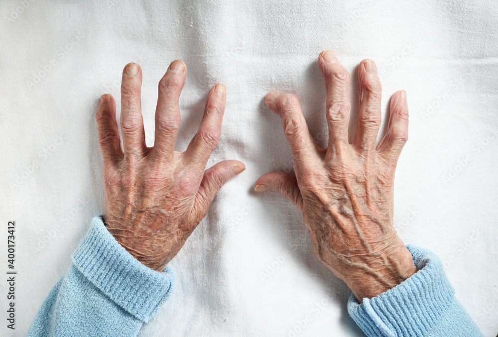 Rheumatoid arthritis of the hands of an elderly 90 year old woman on a ...