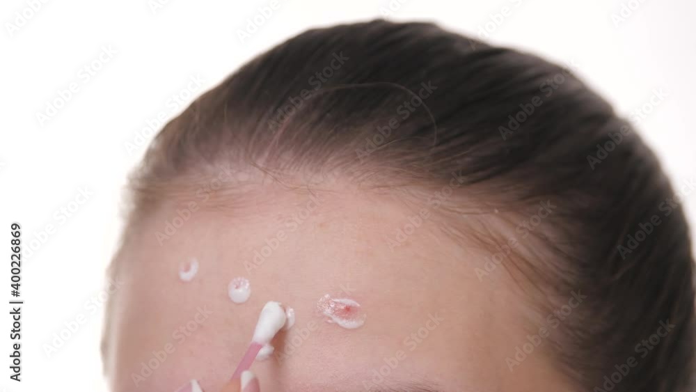 Young skin of the forehead with acne. Getting rid of the rash. Apply a ...