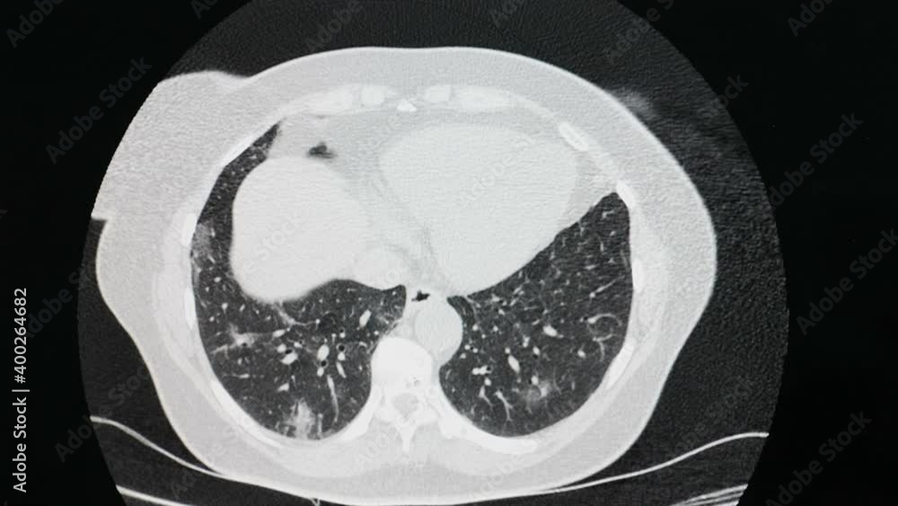 CT of lungs with confirmed case of coronavirus Covid-19 respiratory ...