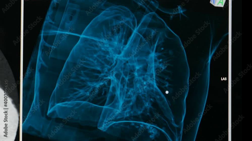 CT of lungs with confirmed case of coronavirus Covid-19 respiratory disease. X-ray Magnetic ...